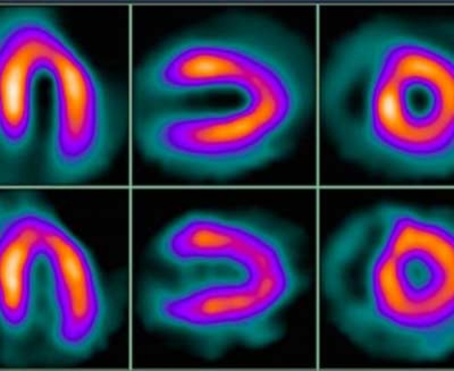 Myocardial Perfusion Imaging Myocardial Perfusion Imaging